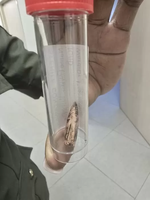 DOCTORS SUCCESSFULLY REMOVE BULLET FROM 16-YEAR-OLD AFTER FIVE YEARS ...